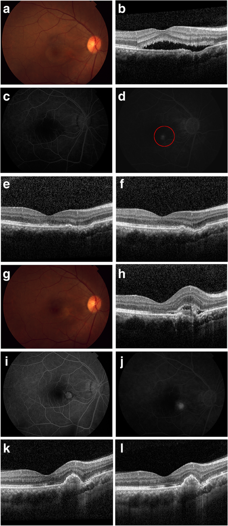 Choroidal neovascularization emerged right from the focal choroidal ...