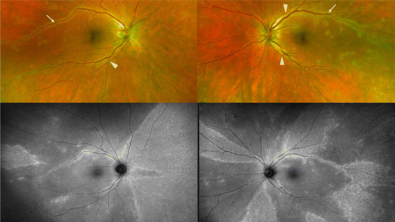 A case of cancer-associated retinopathy with chorioretinitis and optic ...