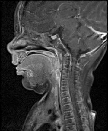 An unusual cause of inspiratory stridor in the newborn: congenital ...