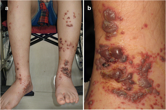Hemorrhagic bullous lesions in Henoch-Schönlein purpura: a case report ...