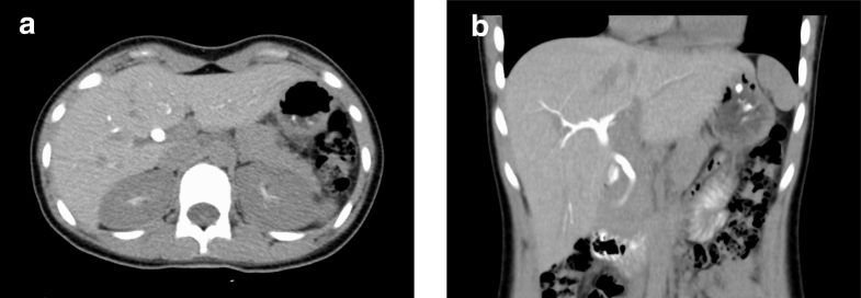Gallbladder agenesis with hepatic impairment: a case report | BMC ...