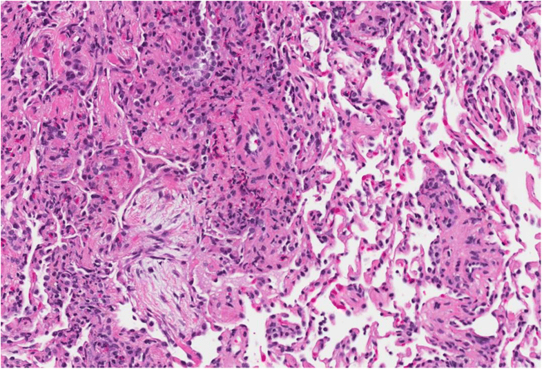 A rare case report of polyangiitis overlap syndrome: granulomatosis ...
