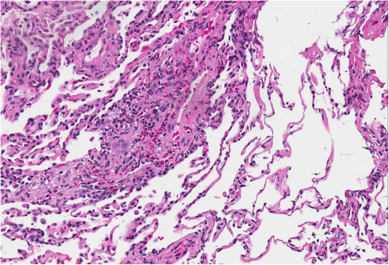 A rare case report of polyangiitis overlap syndrome: granulomatosis ...