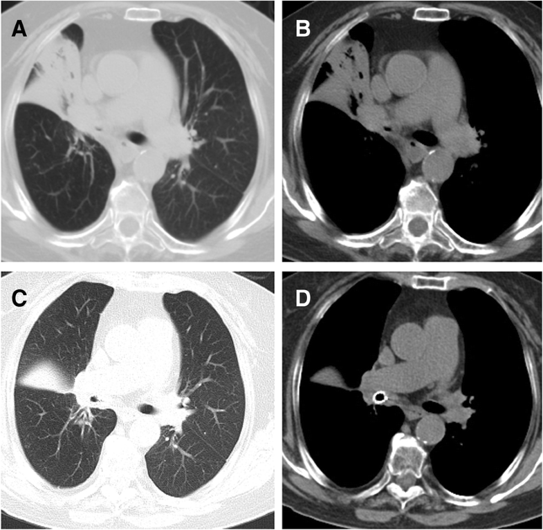 Metallic small y stent placement at primary right carina for bronchial ...