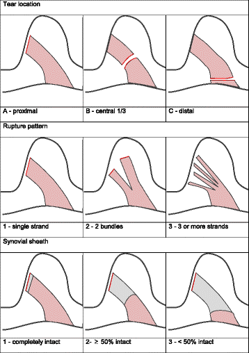 Dynamic Intraligamentary Stabilization (DIS) for treatment of acute ...