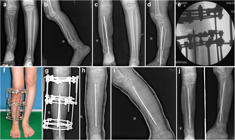 Effect of distraction osteogenesis in patient with tibial shortening ...