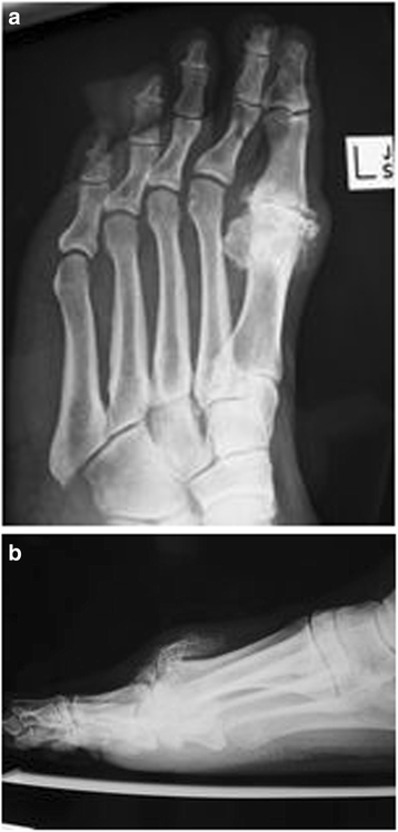 Surgical management of hallux valgus and hallux rigidus: an email ...