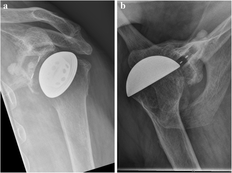 Shoulder joint replacement can improve quality of life and outcome in ...