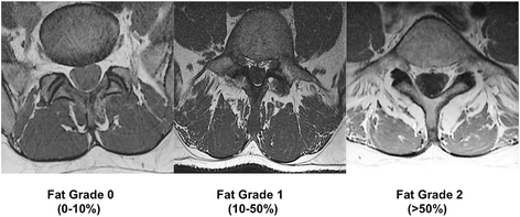 Correlation between lumbar dysfunction and fat infiltration in lumbar ...