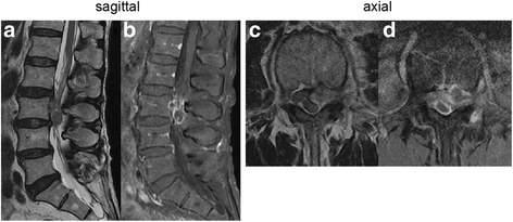 Discography aids definitive diagnosis of posterior epidural migration ...