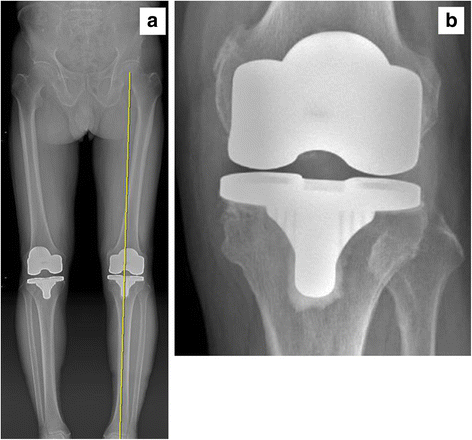 Use of autogenous onlay bone graft for uncontained tibial bone defects ...