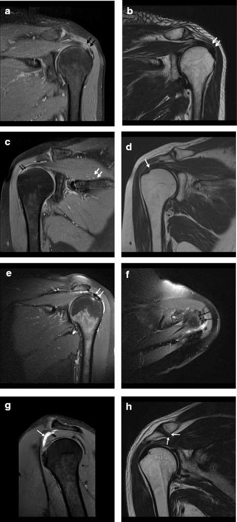 Shoulder MRI features with clinical correlations in subacromial pain ...