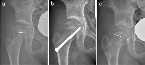 Percutaneous medial hemi-epiphysiodesis using a transphyseal screw for ...