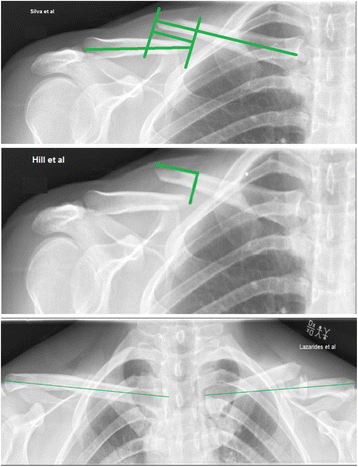 Bone shortening of clavicular fractures: comparison of measurement ...