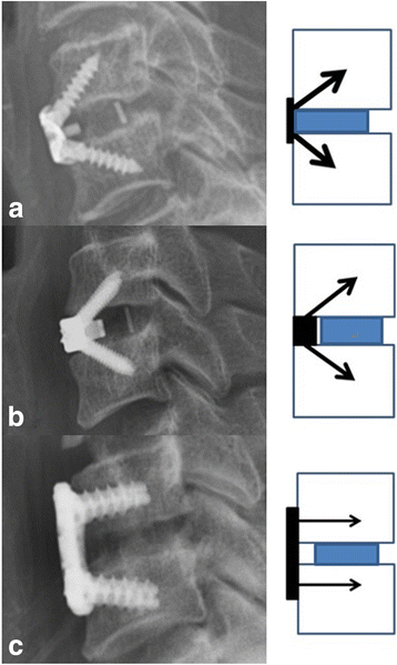 Comparison among perfect-C®, zero-P®, and plates with a cage in single ...
