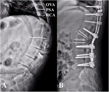 The clinical relevance of the presence of bridging syndesmophytes on ...