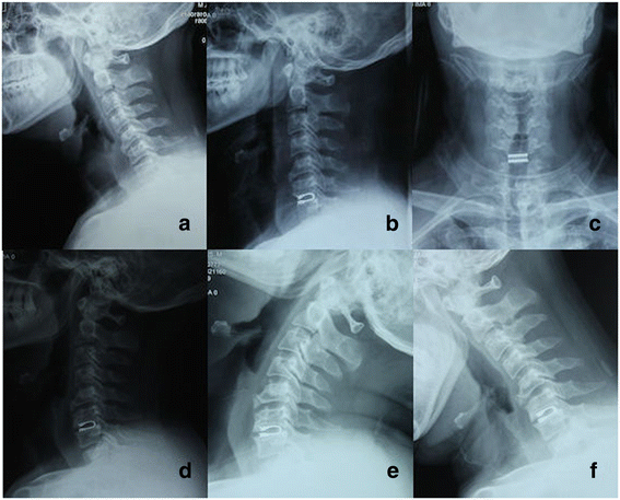 Clinical and radiographic outcome of dynamic cervical implant (DCI ...