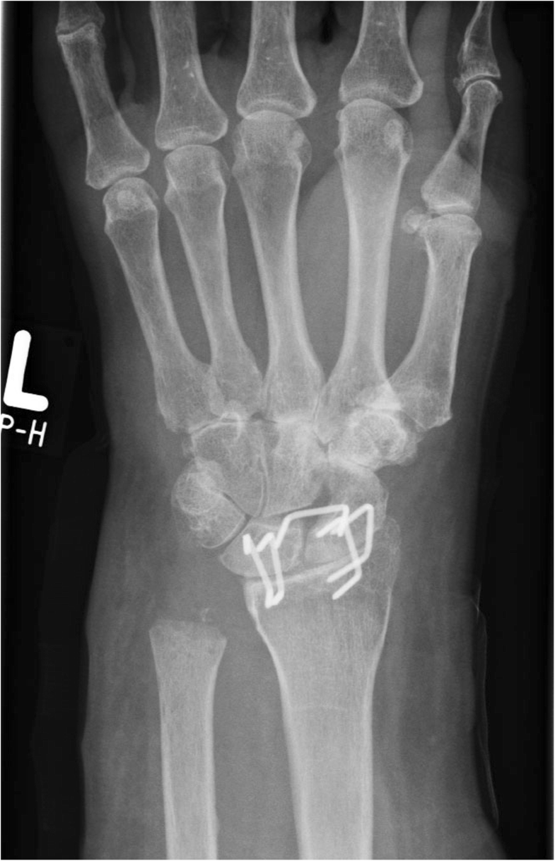 Radiocarpal fusion and midcarpal resection interposition arthroplasty ...