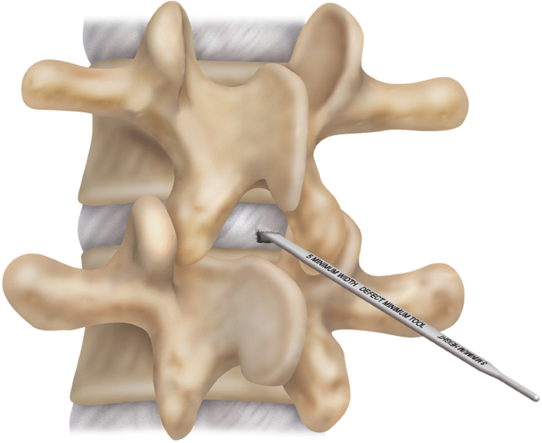 Implantation of a bone-anchored annular closure device in conjunction ...
