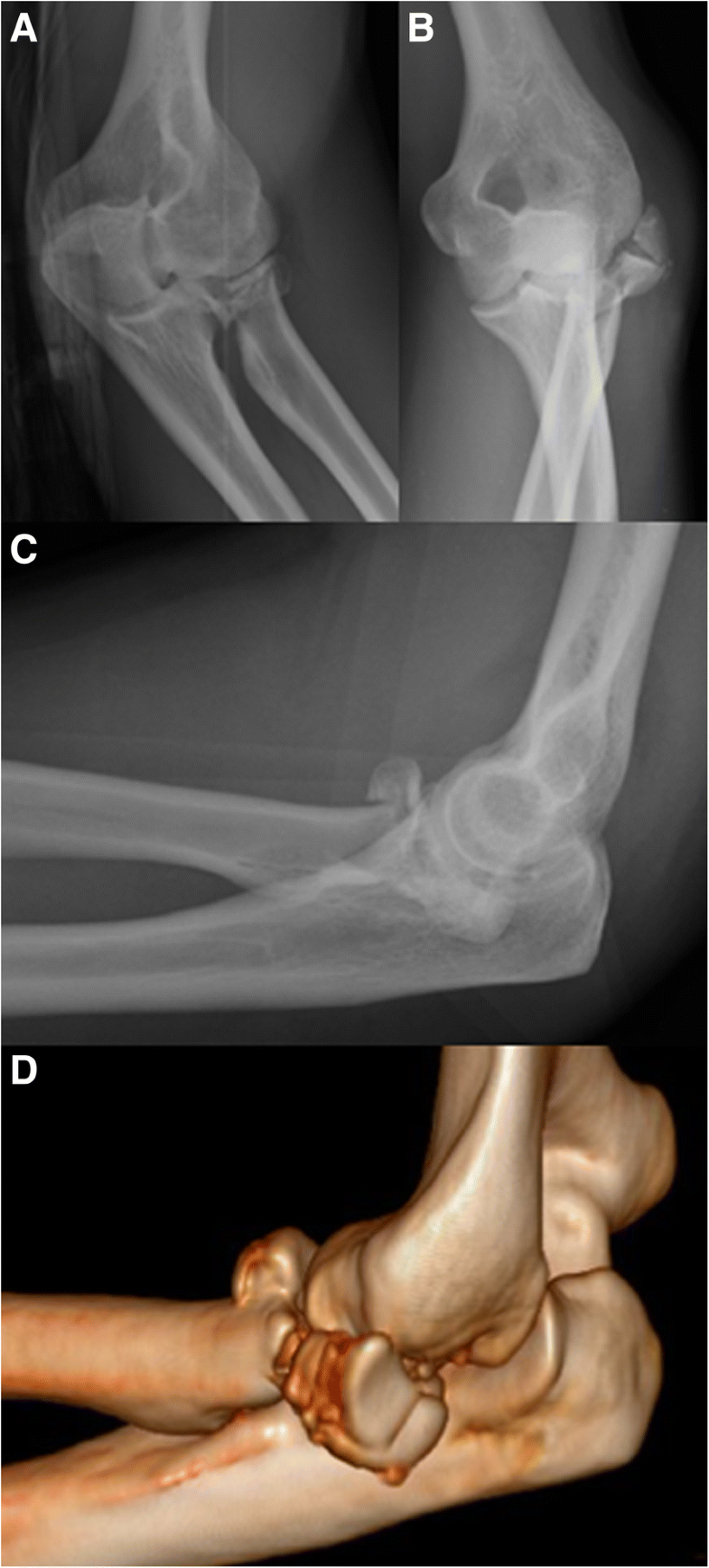 Diagnosis and treatment of acute Essex-Lopresti injury: focus on ...