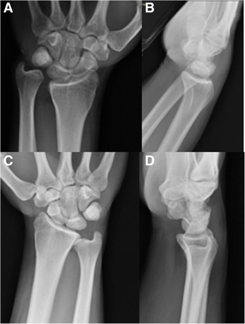 Diagnosis and treatment of acute Essex-Lopresti injury: focus on ...