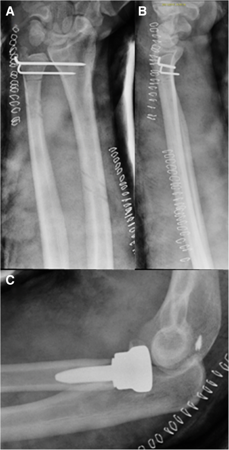Diagnosis and treatment of acute Essex-Lopresti injury: focus on ...