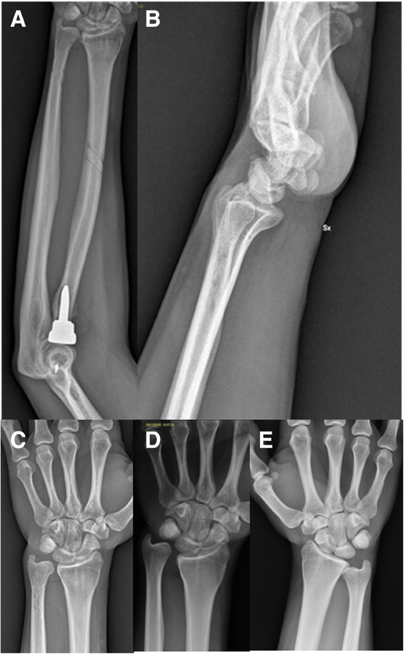Diagnosis and treatment of acute Essex-Lopresti injury: focus on ...