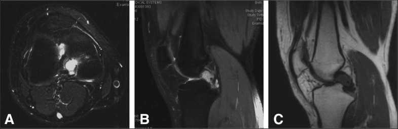 Intra-articular nodular fasciitis: a rare lesion case report and an updated review of the ...