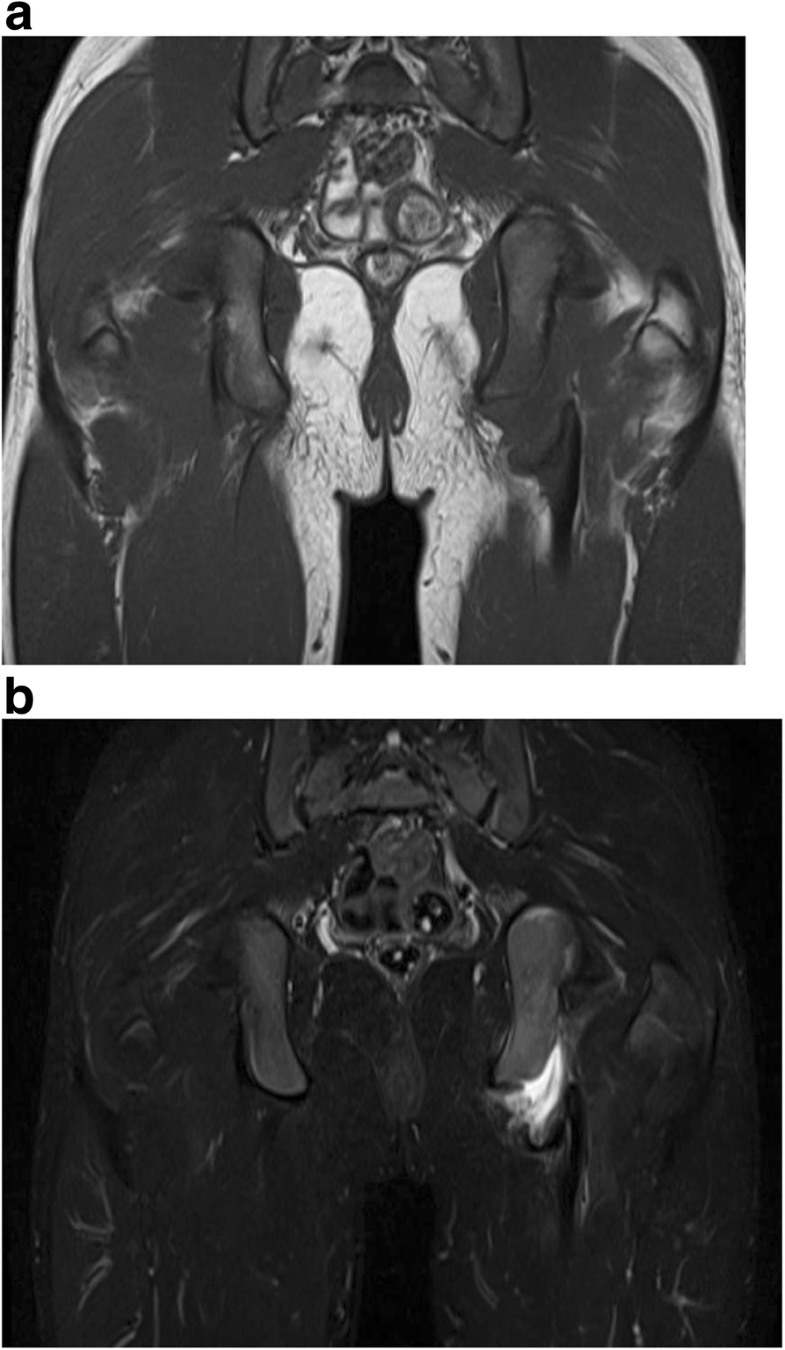 Avulsion fracture of the ischial tuberosity treated with the suture ...