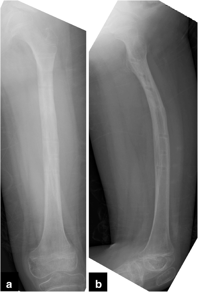 Recurrent femoral shaft fractures in a child with gnathodiaphyseal ...