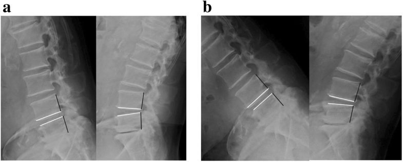Unilateral laminectomy for bilateral decompression improves low back ...