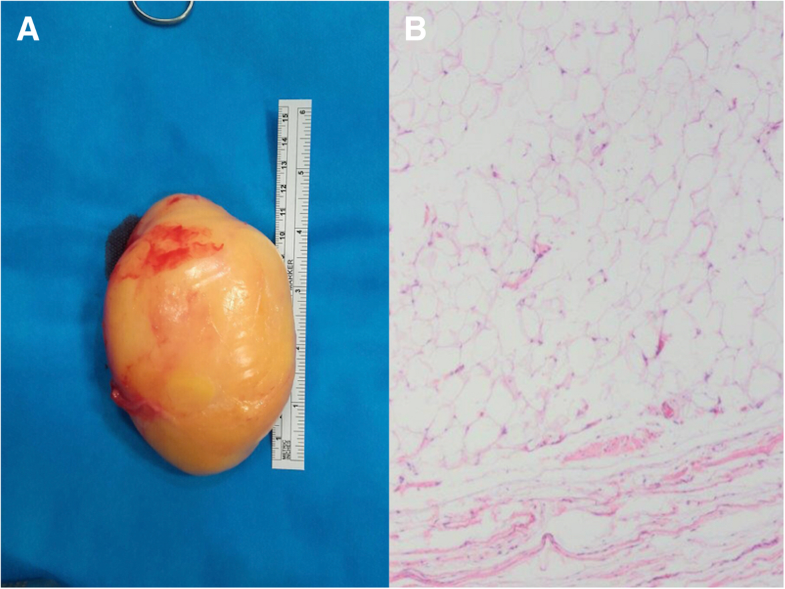 Large intra-articular true lipoma of the knee | BMC Musculoskeletal ...