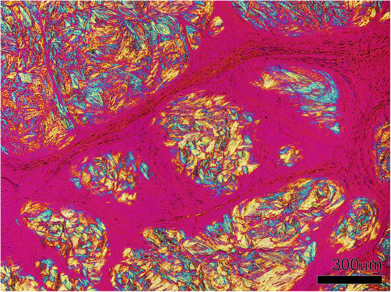 The anatomical pathology of gout: a systematic literature review | BMC ...