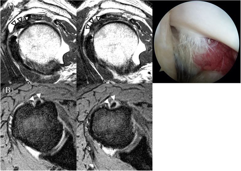 Accuracy of MRI in diagnosing intra-articular pathology of the long ...