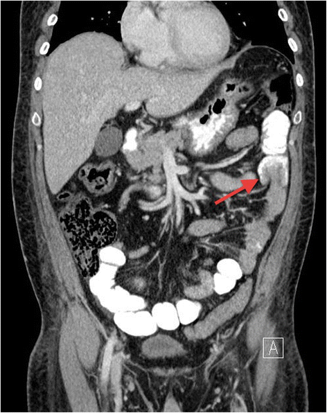 Transient small bowel intussusception in an adult: case report with ...