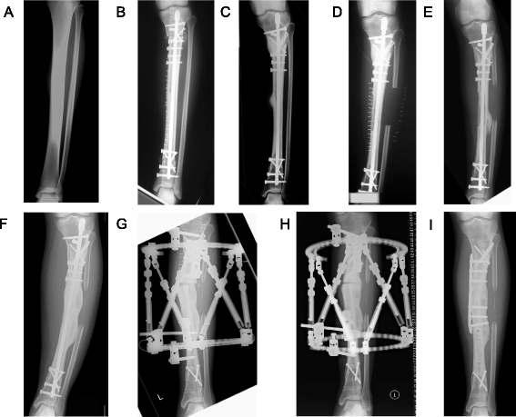 Successful correction of tibial bone deformity through multiple ...