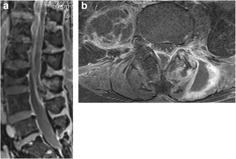 Lumbar spine epidural abscess and facet joint septic arthritis due to Streptococcus agalactiae ...