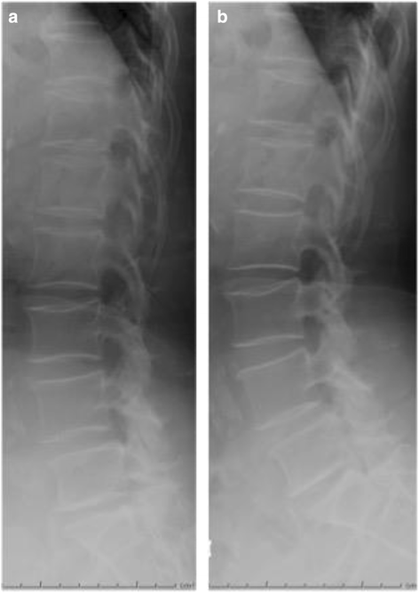 Lumbar spine epidural abscess and facet joint septic arthritis due to Streptococcus agalactiae ...