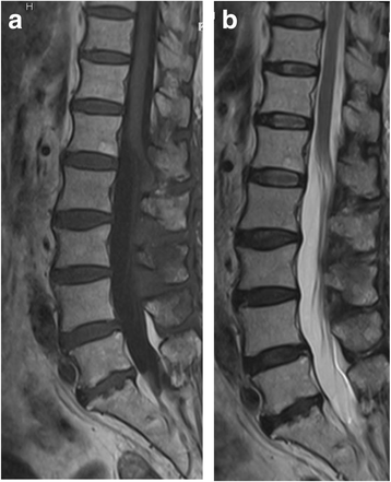 Lumbar spine epidural abscess and facet joint septic arthritis due to Streptococcus agalactiae ...
