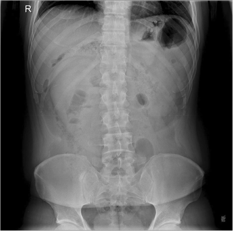 Para-duodenal hernia: a report of five cases and review of literature ...
