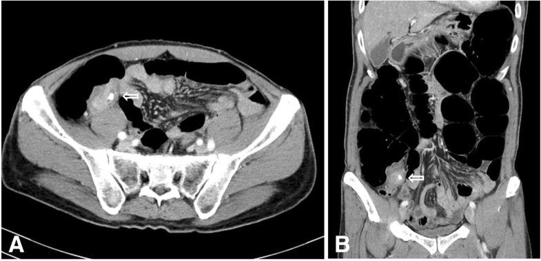 Appendiceal intussusception requiring an ileocecectomy: a case report ...
