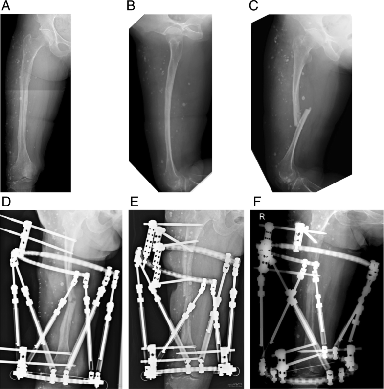 Successful treatment of pathologic femoral shaft fracture associated ...