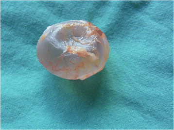 Testicular prostheses in patients with testicular cancer - acceptance ...