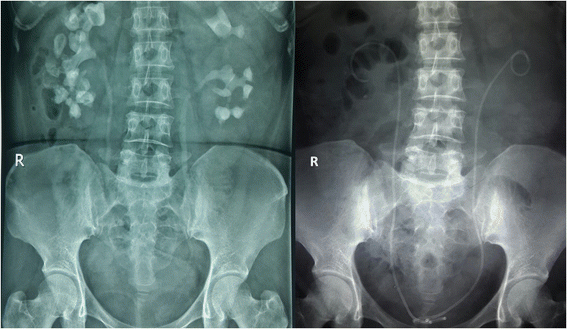 Multi-tract percutaneous nephrolithotomy combined with EMS lithotripsy ...