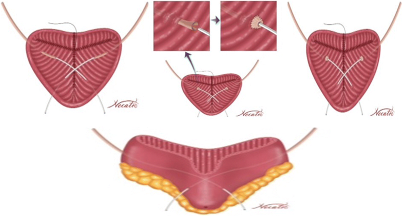 The surgical technique and initial outcomes of Anatolian neobladder: a ...