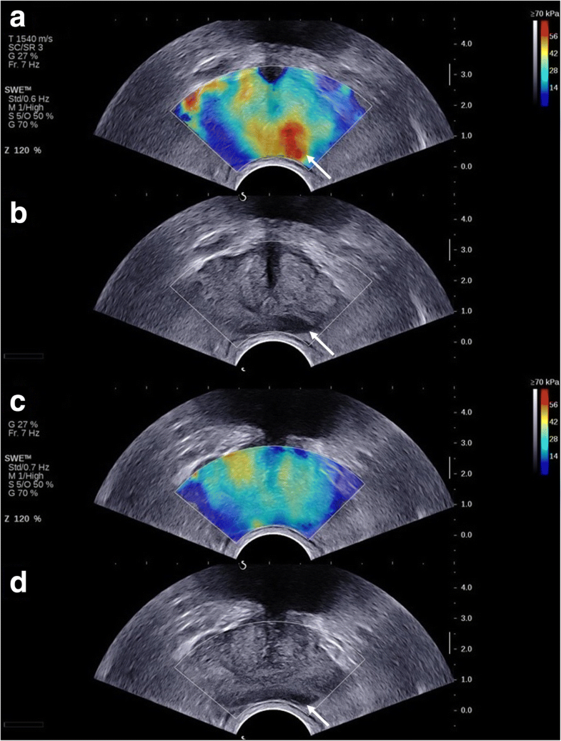 Multiparametric ultrasound: evaluation of greyscale, shear wave ...
