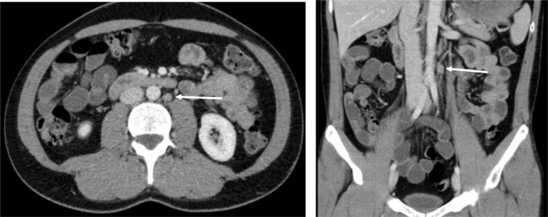 Is there still a place for retroperitoneal lymph node dissection in ...