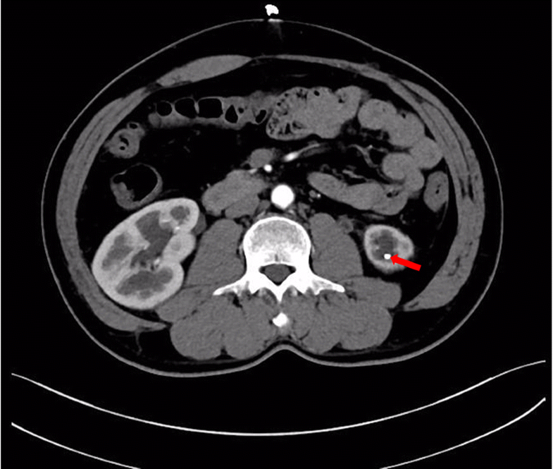 Treatment of urinary calculi after Yang-Monti ileal ureter ...
