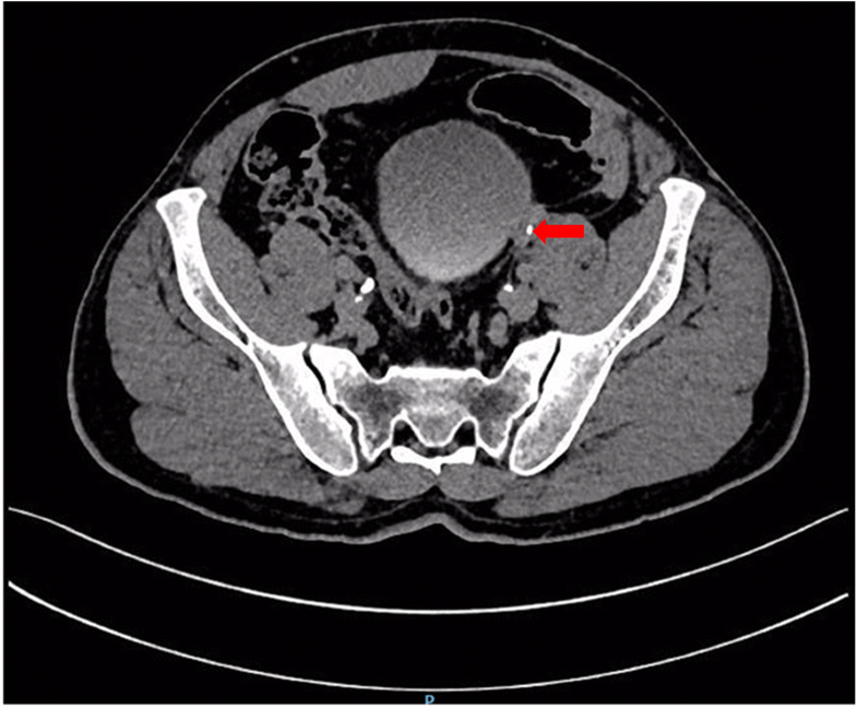 Treatment of urinary calculi after Yang-Monti ileal ureter ...