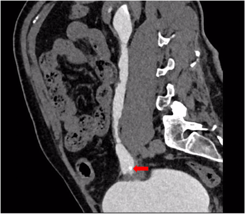 Treatment of urinary calculi after Yang-Monti ileal ureter ...